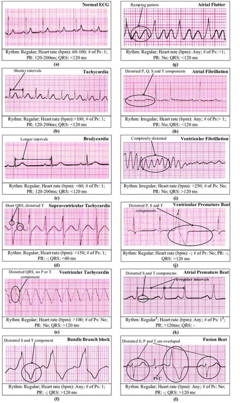 Cardiac Dysrhythmias Pdf Electrocardiography Cardiovascular System Artofit