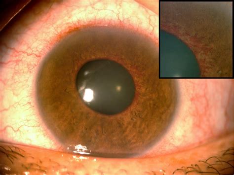 Neovascular Glaucoma Premium Vector Inflammatory Glaucoma