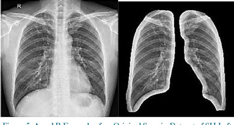 Figure 1 From Deep Learning Models For Classification Of Lung Diseases Semantic Scholar