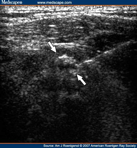 Sonographically Guided Percutaneous Needle Lavage In Calcific Tendinitis