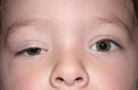 Ptosis Drooping Eyelids Fort Worth Eye Associates
