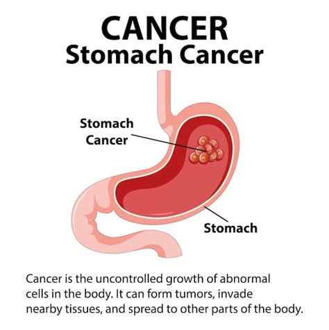 Free Vector Illustrated Infographic Stomach Cancer And Abnormal Cell