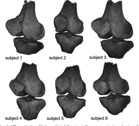 Figure 1 From A Fully Automated Trabecular Bone Structural Analysis Tool Based On T2 Weighted