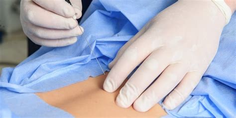Are Spinal Cord Stimulators Safe What You Need To Know