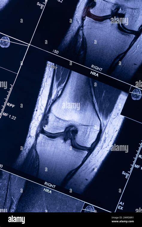 Xray Mri Examination Magnetic Resonance Images Showing Real Fracture