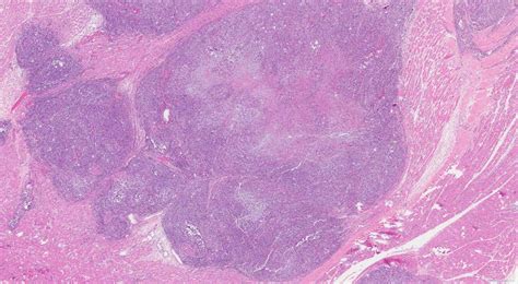 Epithelioid Sarcoma Ottawa Atlas Of Pathology