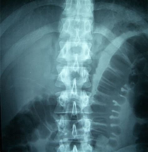 Fracture Of Transverse Process