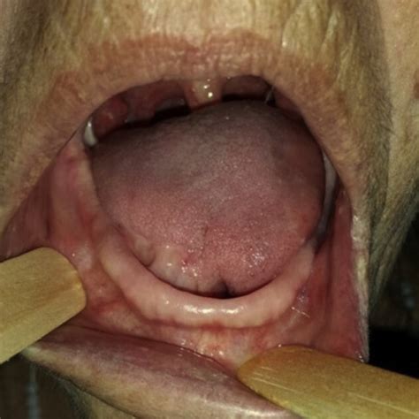 Partial Glossectomy Download Scientific Diagram