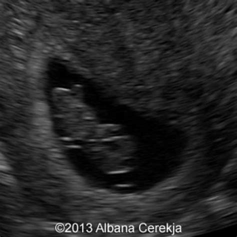 What Are Vocal Cord Cysts Isaac Namdar Md