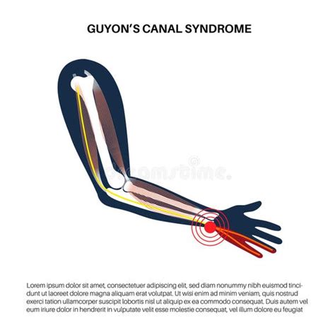 Canal Syndrome Stock Illustrations 78 Canal Syndrome Stock