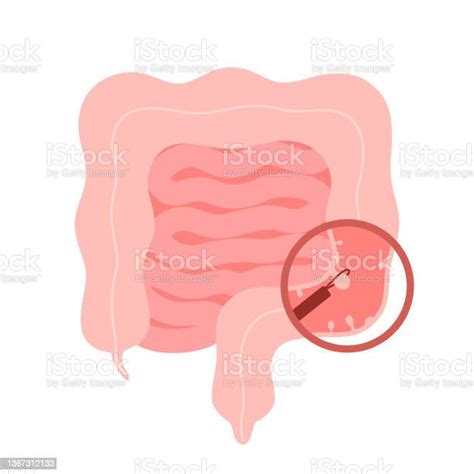 Colonoscopy Intestine Polypectomy Procedure Removal Polyp In Colon