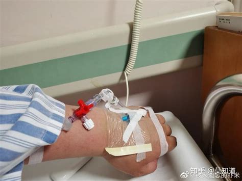 坎坷的肛瘘治疗经历5（手术2个月后复发） 知乎