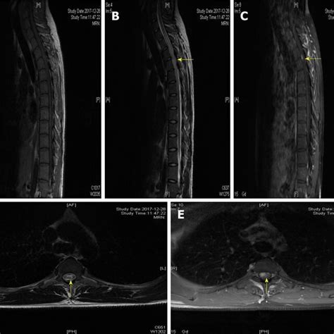 Spinal Cord Magnetic Resonance Imaging Showed Abnormal Longitudinally