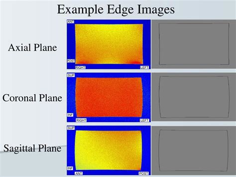 Ppt Software Development For Correction Of Gradient Nonlinearity Distortions In Mr Images