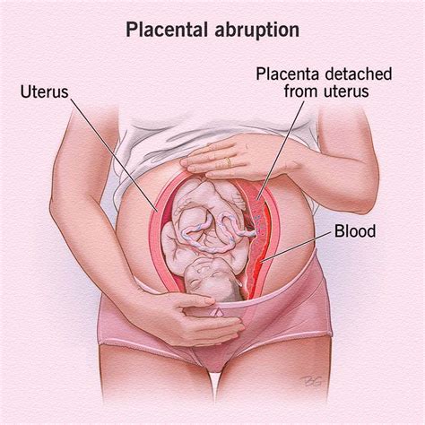 Pregnancy ⚠️ Placental Abruption What To Do A Rare But Serious