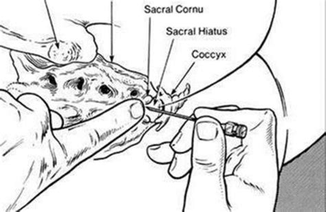 Caudal Block Insertion Technique Flashcards Quizlet