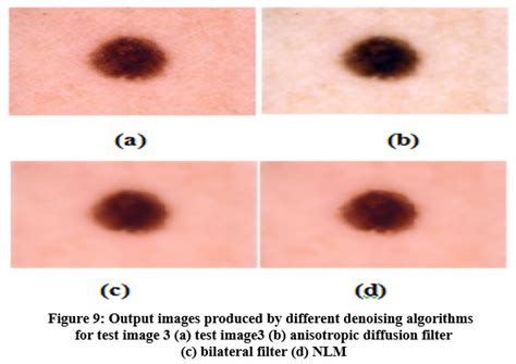 Preprocessing Of Skin Cancer Images Using Non Local Means Nlm Filter