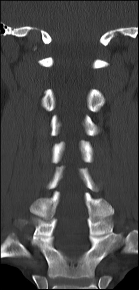 Radiopaedia Case Accessory Articulation Of The Cervical Transverse