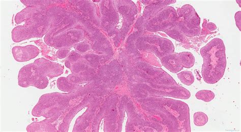 Hpv Associated Squamous Cell Carcinoma Of The Oropharynx Atlas Of