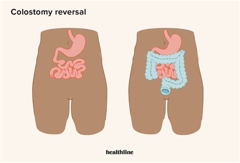 Loop Colostomy Reversal