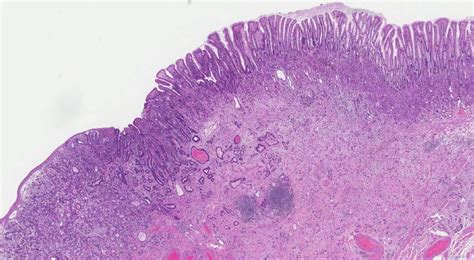 Invasive Adenocarcinoma Archives Ottawa Atlas Of Pathology