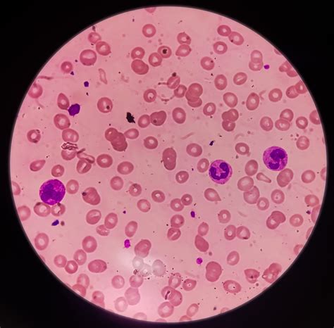 Vitamin B12 And Folate Pathology Tests Explained