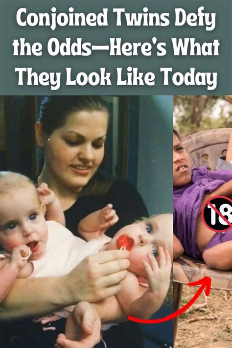 Conjoined Twins Defy The Odds—heres What They Look Like Today Conjoined Twins Bizarro Comic
