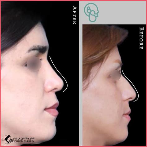 المواصفات والسعر وشراء تجميل الأنف الدكتور بابك ساعدي