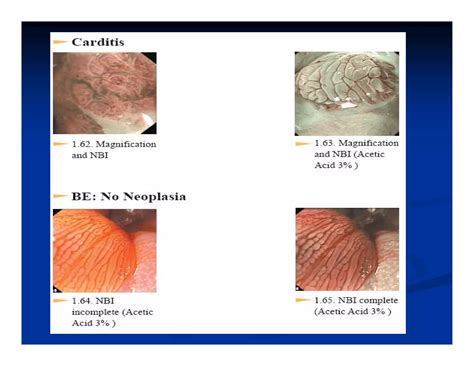 Colonic Polyposis Ppt