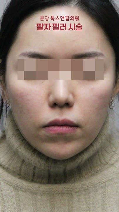 팔자주름이 깊어지면 스트레스도 깊어지죠 팔자주름필러전후 Youtube