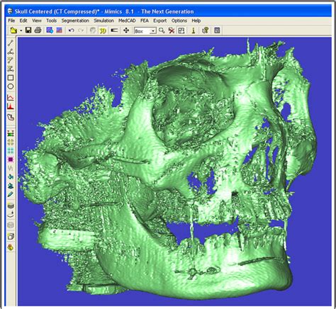 Figure 4 From Accuracy And Reliability Of Cone Beam Computed Tomography Measurements Influence