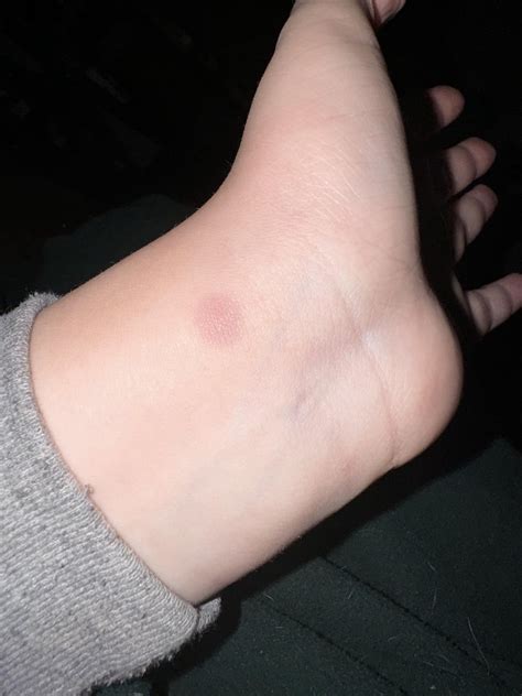 Noticed This Random Bruise Thats Almost Perfectly Circular Today R