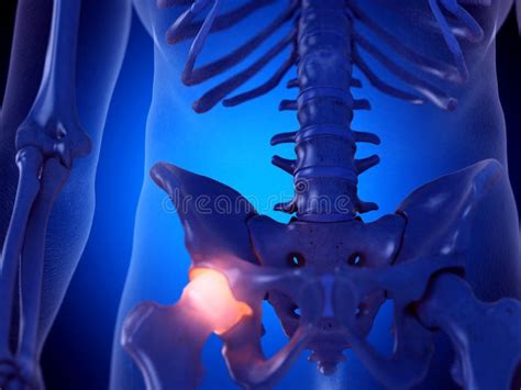 A Painful Hip Joint Stock Illustration Illustration Of Health 169372615