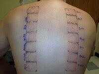 Epicutaneous Patch Testing Wiki Talktorrent93s Blog