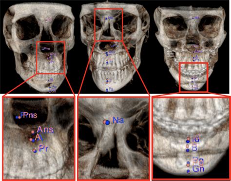 Relational Reasoning Network For Anatomical Landmarking