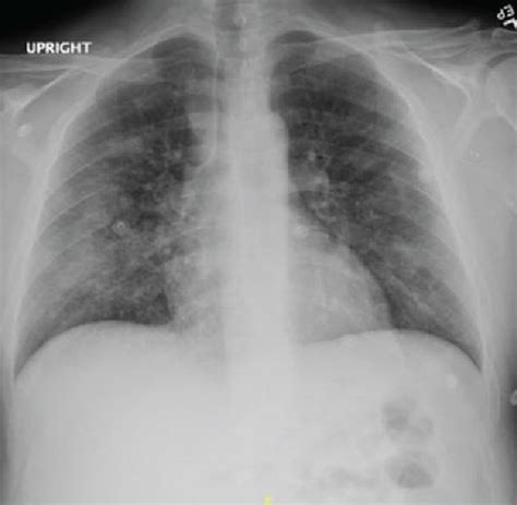 Chest X Ray Showing Diffuse Bilateral Infiltrates More Pronounced On Download Scientific