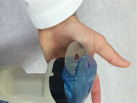 How To Safely Remove A Cast With A Saw