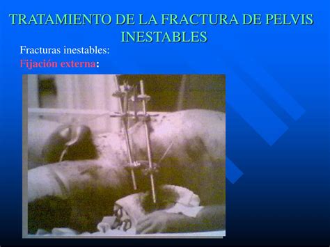 Ppt Tratamiento De La Fractura De Pelvis Powerpoint Presentation