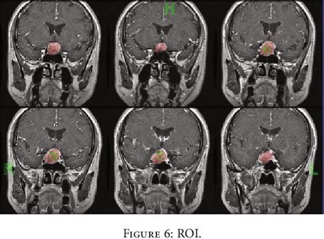 Figure 1 From Mr Image Classification For Brain Tumor Texture Based On Pseudo Label Learning And