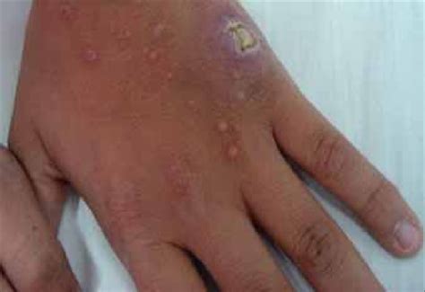 Vesiculopustular Lesions Of Varicella Around Leishmaniasis Ulcer On The