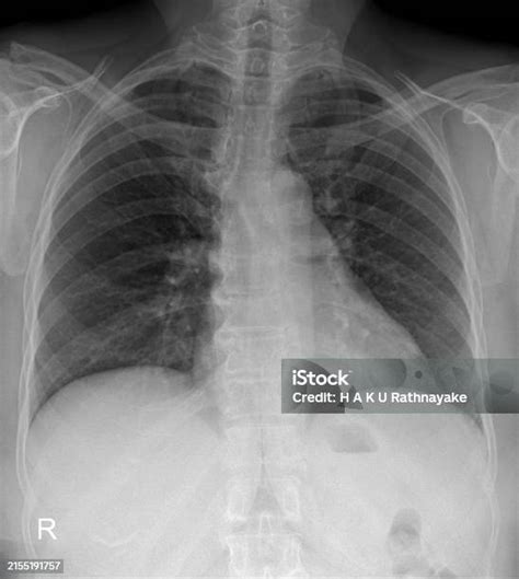 Radiografía De Tórax De Alta Resolución De La Cavidad Torácica Foto De