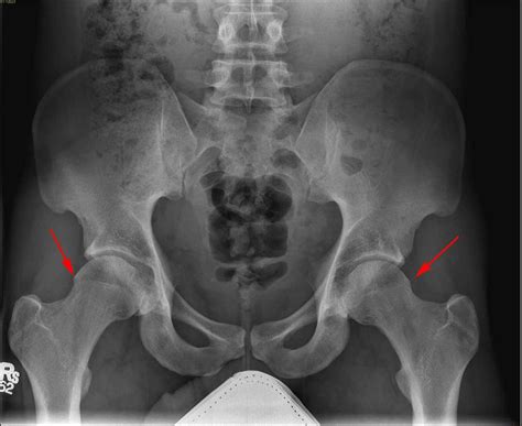 Femoroacetabular Impingement Fai X Rays Radiology Case Studies