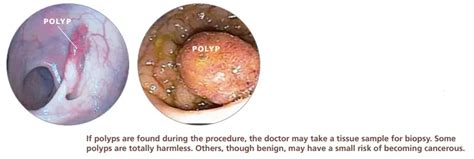 Flexible Sigmoidoscopy Gastroenterologist In Forest Hills Ny