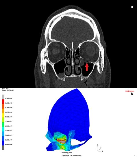 ct scan analysis and the impacting load assessment a exemplary