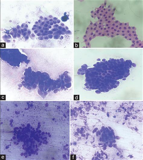 Fine Needle Aspiration Cytology Of Gallbladder With An Attempt Of