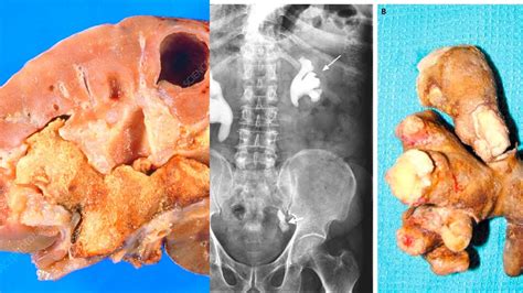 STAGHORN KIDNEY STONES What Causes That Staghorn Calculi Treatment