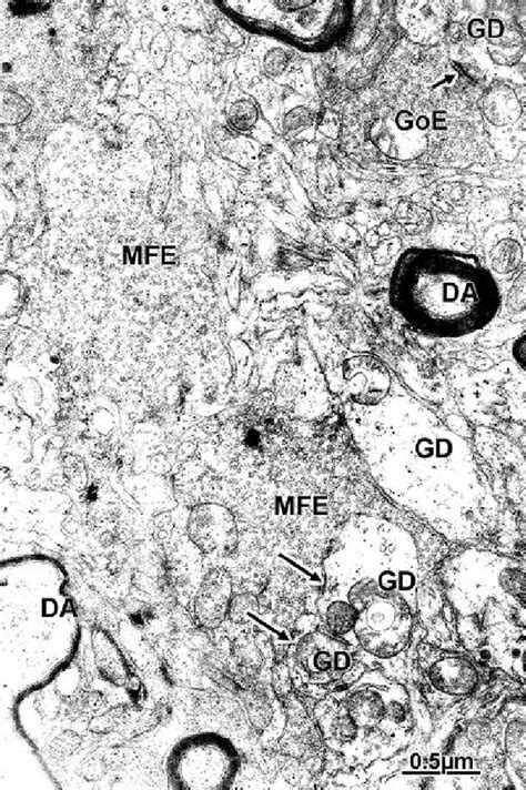 Cerebellar Meningioma Cerebellar Cortex Granular Layer Notably Download Scientific Diagram