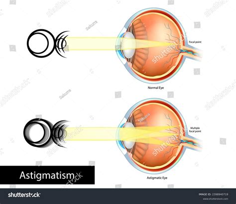 Astigmatic Eye Normal Eye Astigmatism Refractive Stock Vector Royalty