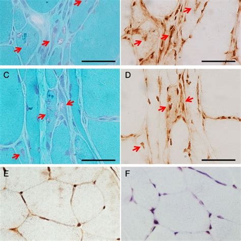 Histological Findings In Sections Of The Muscle Biopsy Specimens