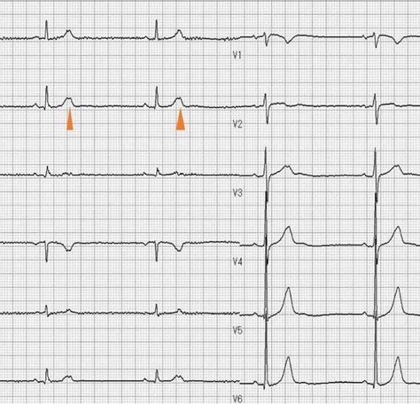 A Standard 12‐lead Electrocardiogram Before Ablation Orange Arrows